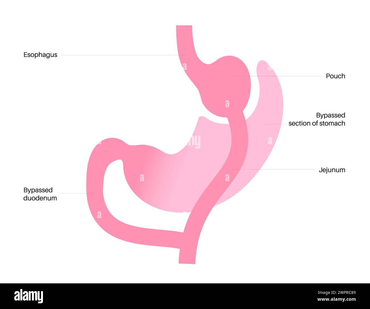 Magenbypass operation Ausgeschnittene Stockfotos und -bilder - Alamy