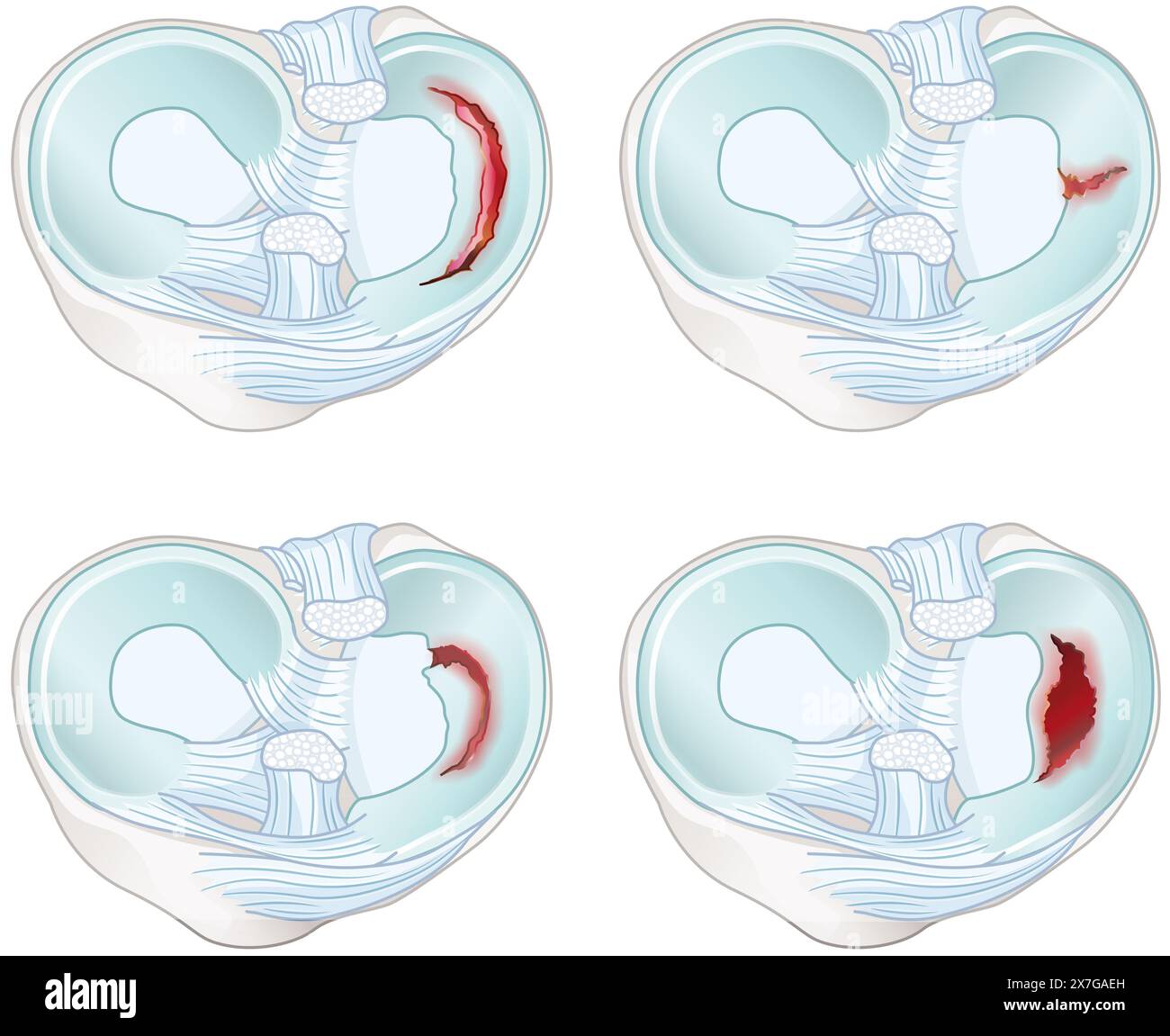 Knie meniskus -Fotos und -Bildmaterial in hoher Auflösung – Alamy