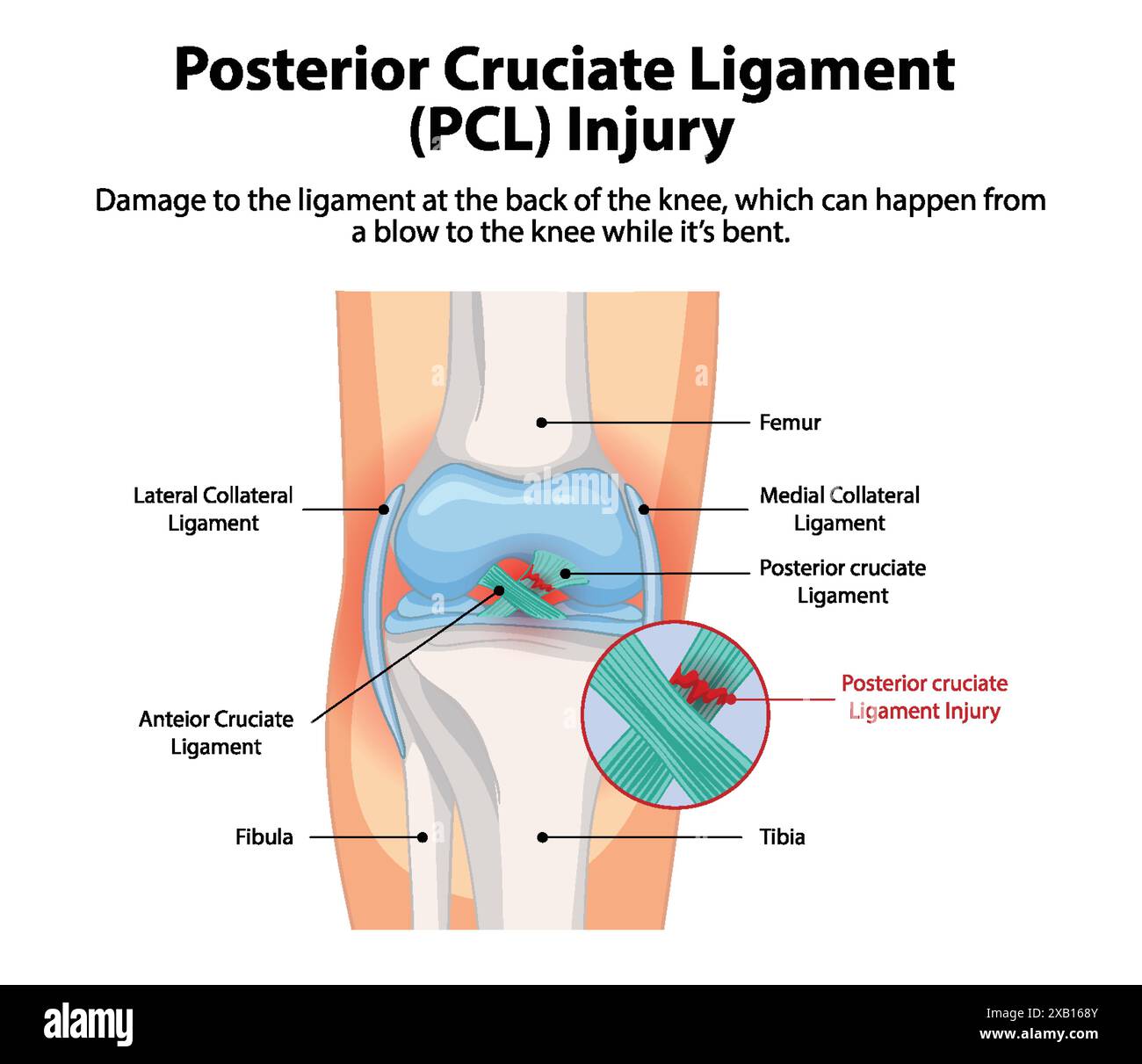 Cruciate ligaments Stock-Vektorgrafiken kaufen - Alamy