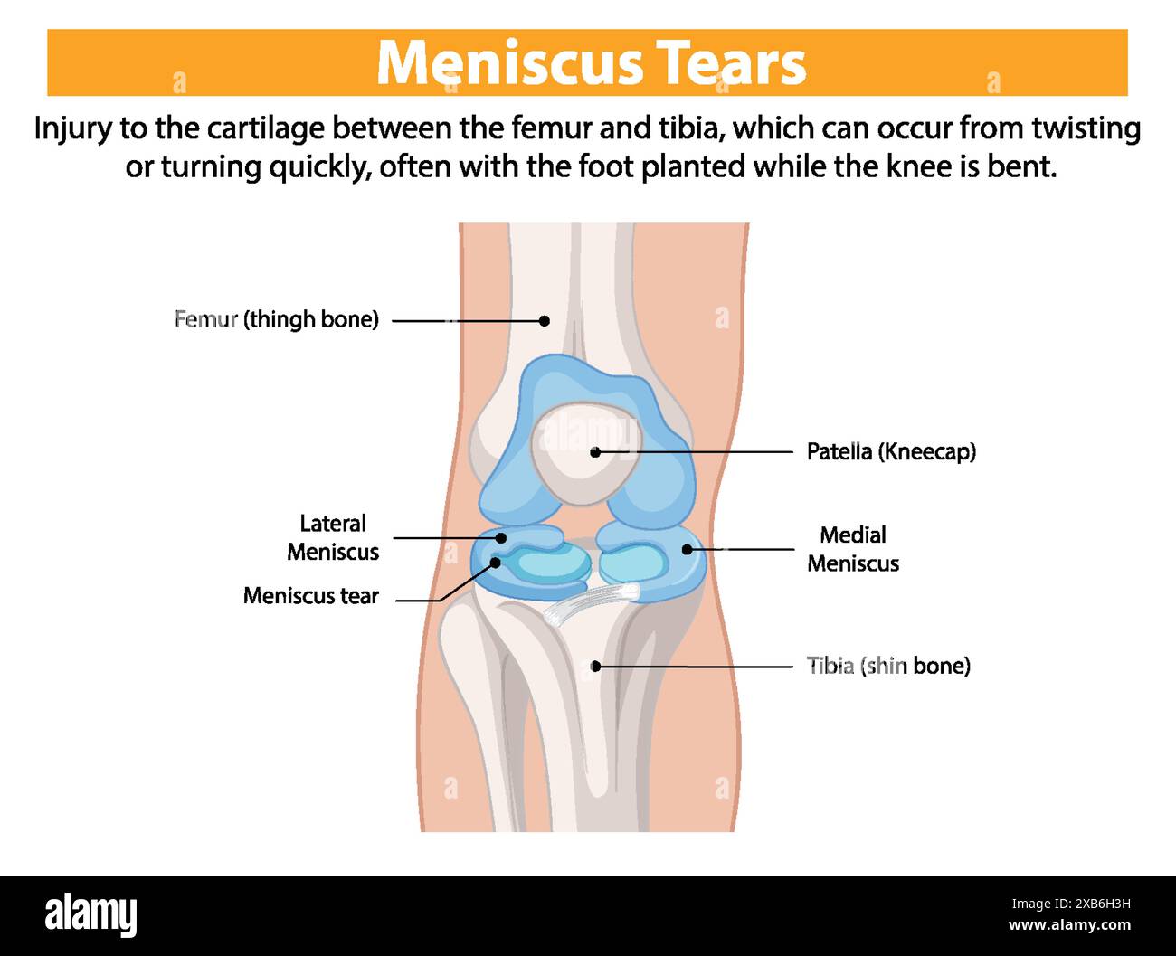 Meniskus medialis und meniskus lateralis -Fotos und -Bildmaterial in ...