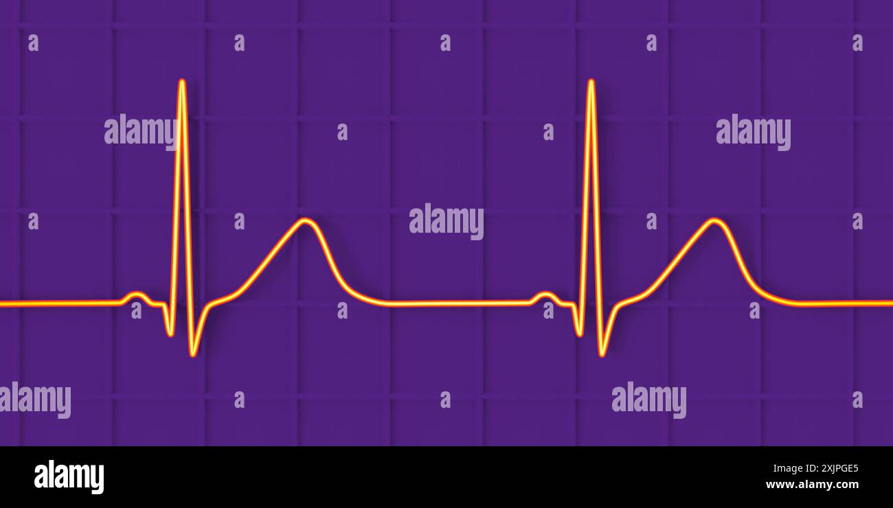 Illustration eines Elektrokardiogramms (EKG) mit verlängertem QT ...
