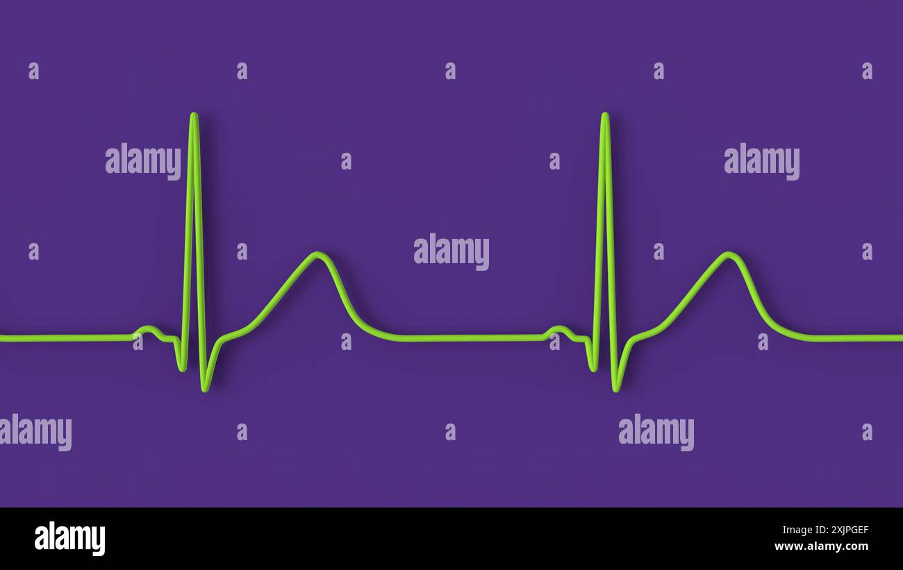 Illustration eines Elektrokardiogramms (EKG) mit verlängertem QT ...
