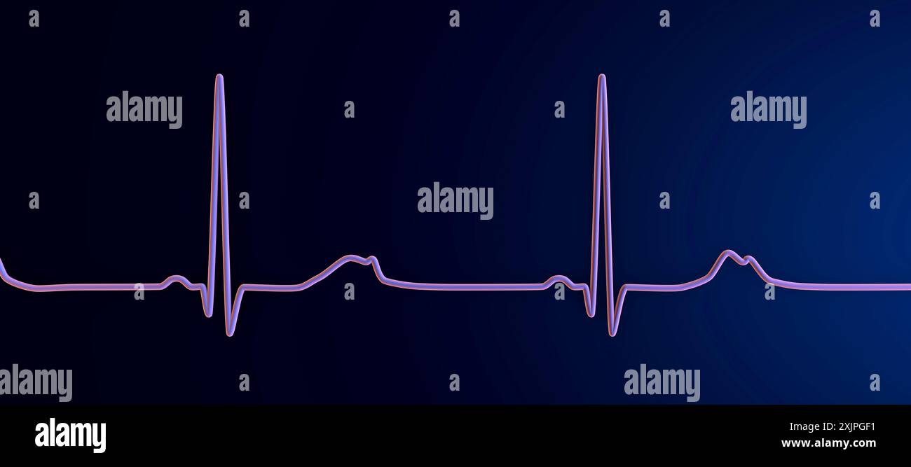 Abbildung eines Elektrokardiogramms (EKG) mit verlängertem QT-Intervall ...