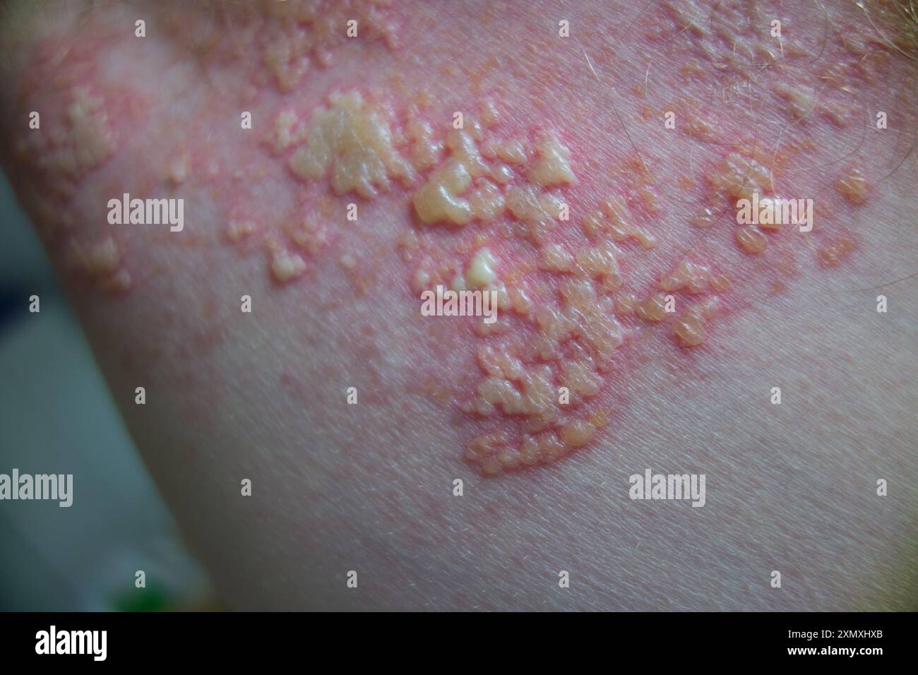 Gürtelrose ausschlag -Fotos und -Bildmaterial in hoher Auflösung – Alamy