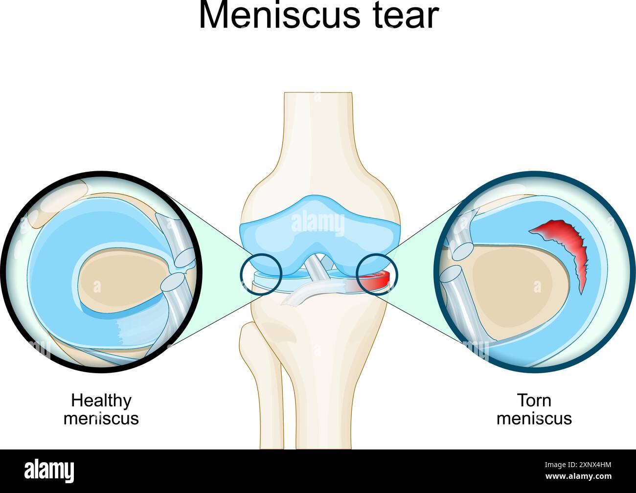 Gerissenen meniskus -Fotos und -Bildmaterial in hoher Auflösung – Alamy