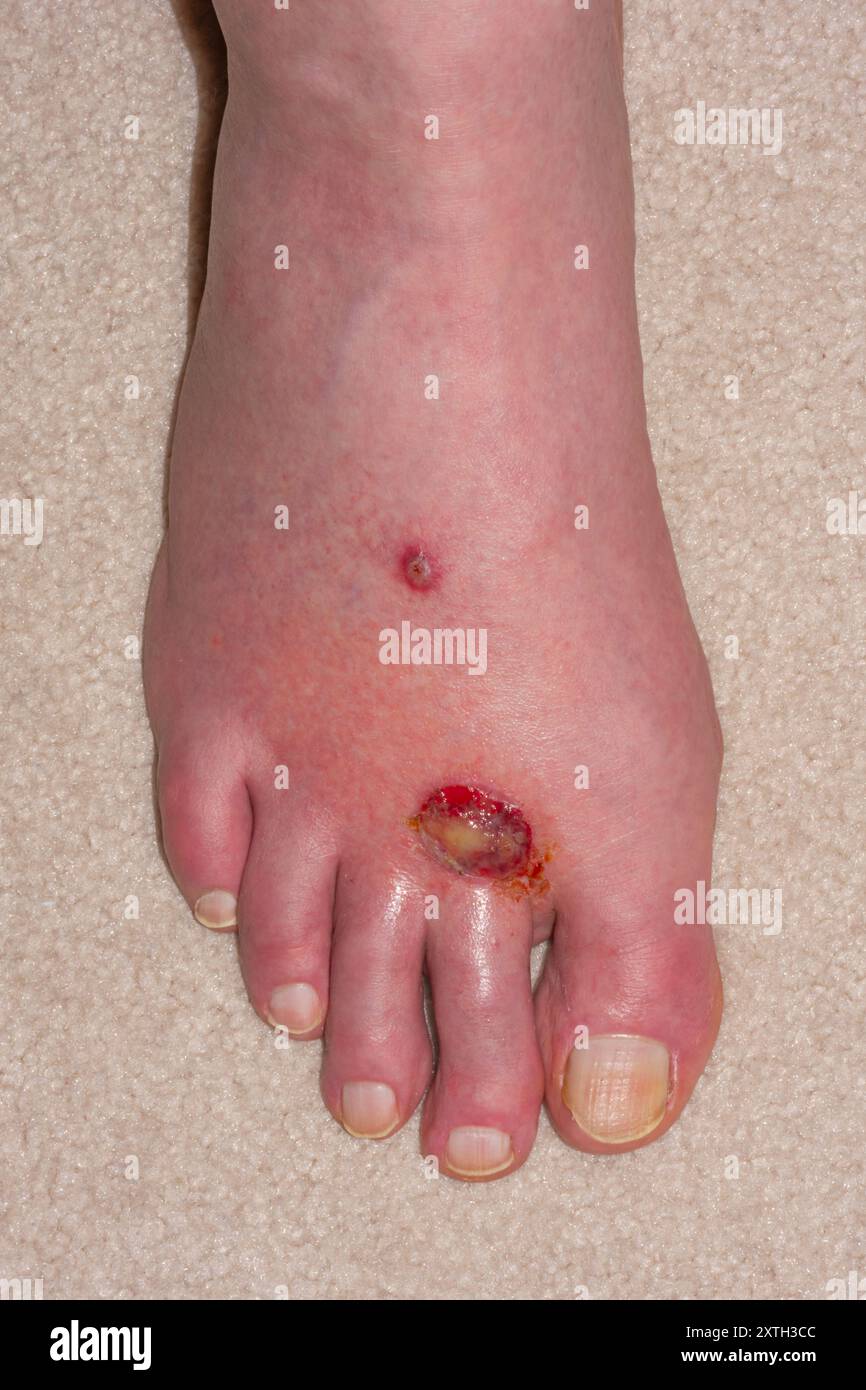 Ausschlag milben -Fotos und -Bildmaterial in hoher Auflösung – Alamy