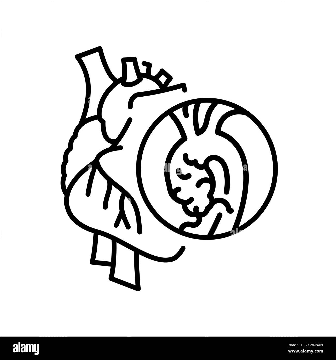 Abdominal aorta aneurysm Stock-Vektorgrafiken kaufen - Alamy