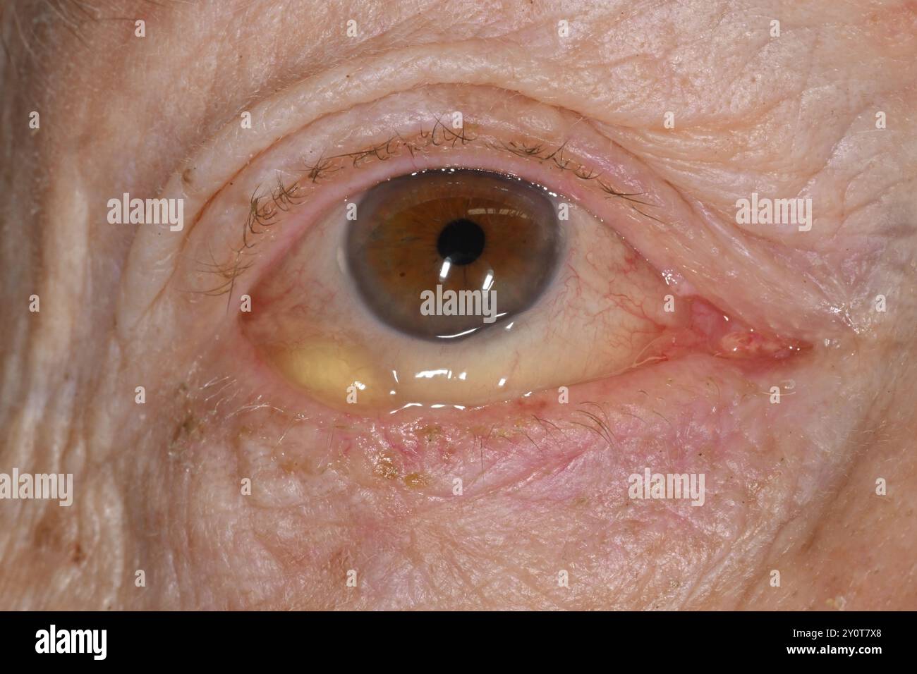 Bindehautoedem im Auge eines 89jährigen männlichen Patienten. Das weiß ...