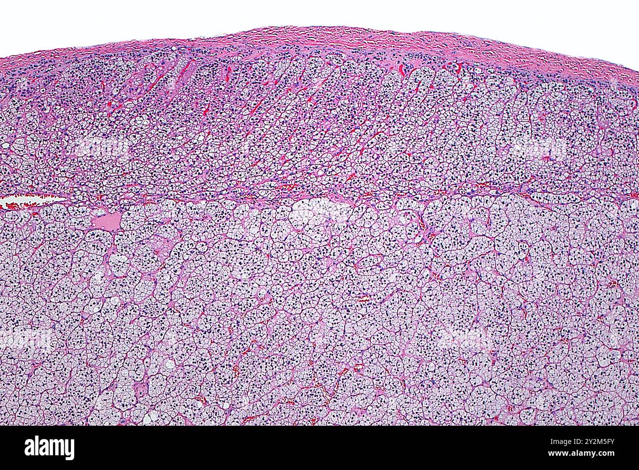 Lichtmikroskop eines Nebennierenrindenadenoms. Ein ...