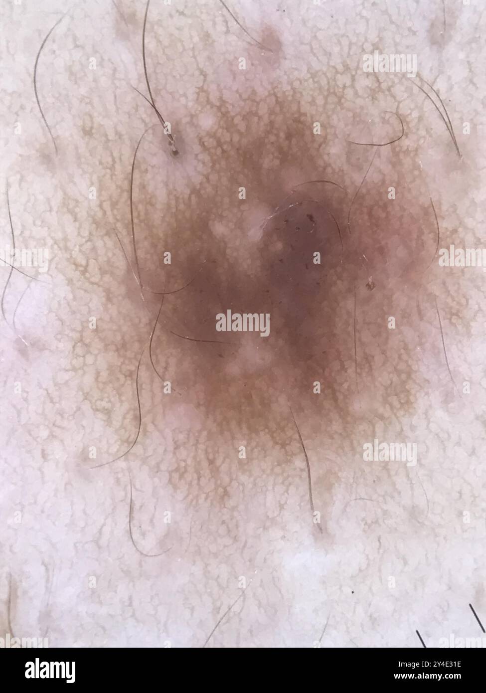 Dermatoskopbild eines Dermatofibroms auf der Haut eines Patienten ...