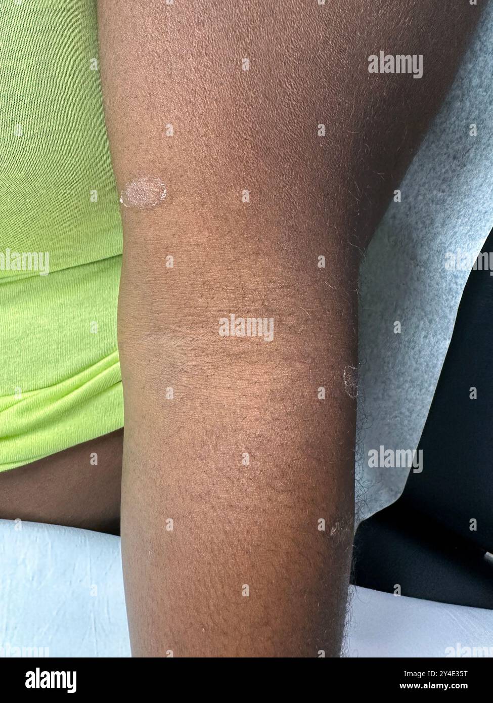 Tinea corporis am Arm eines afroamerikanischen Patienten. Tinea, auch ...