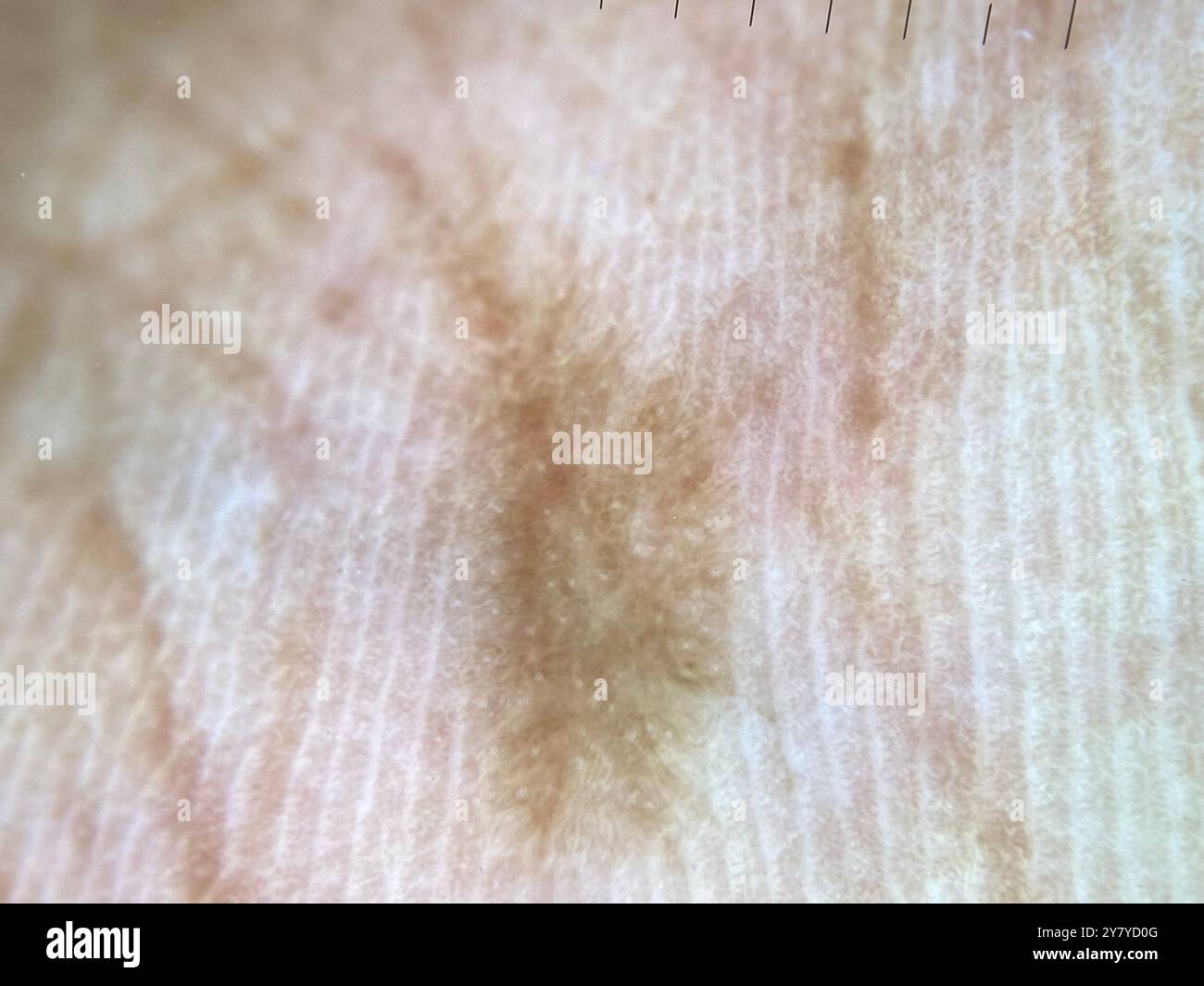 Dermatoskopbild eines Maulwurfes an der Hand einer 30-jährigen ...