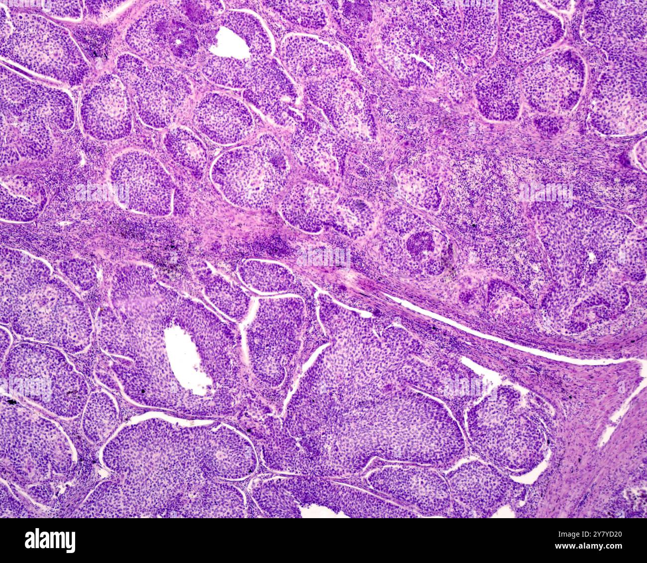 Lichtmikroskop eines schlecht differenzierten Plattenepithelkarzinoms ...