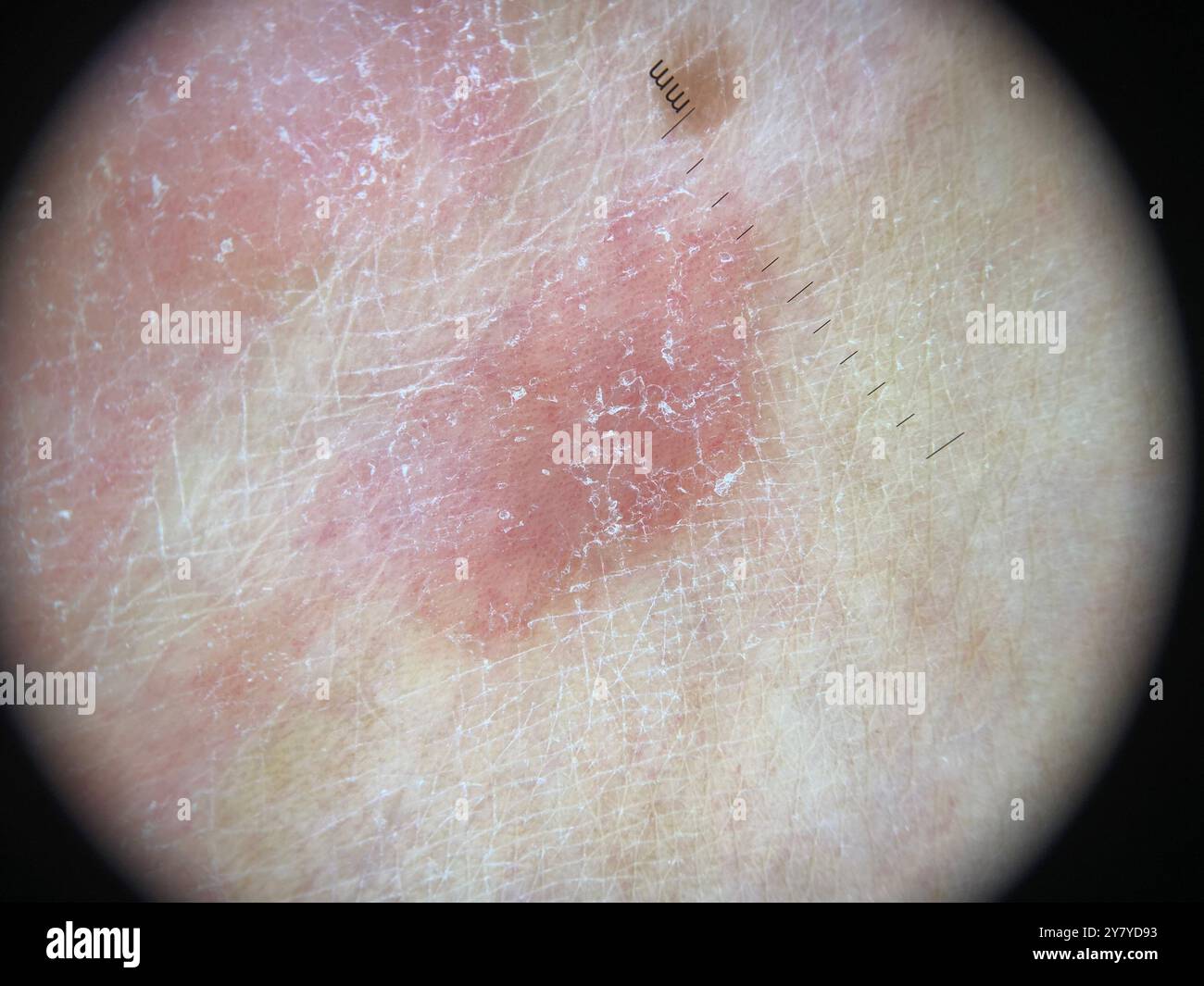 Dermatoskopbild einer Ringelwurminfektion an der Leistengegend eines ...