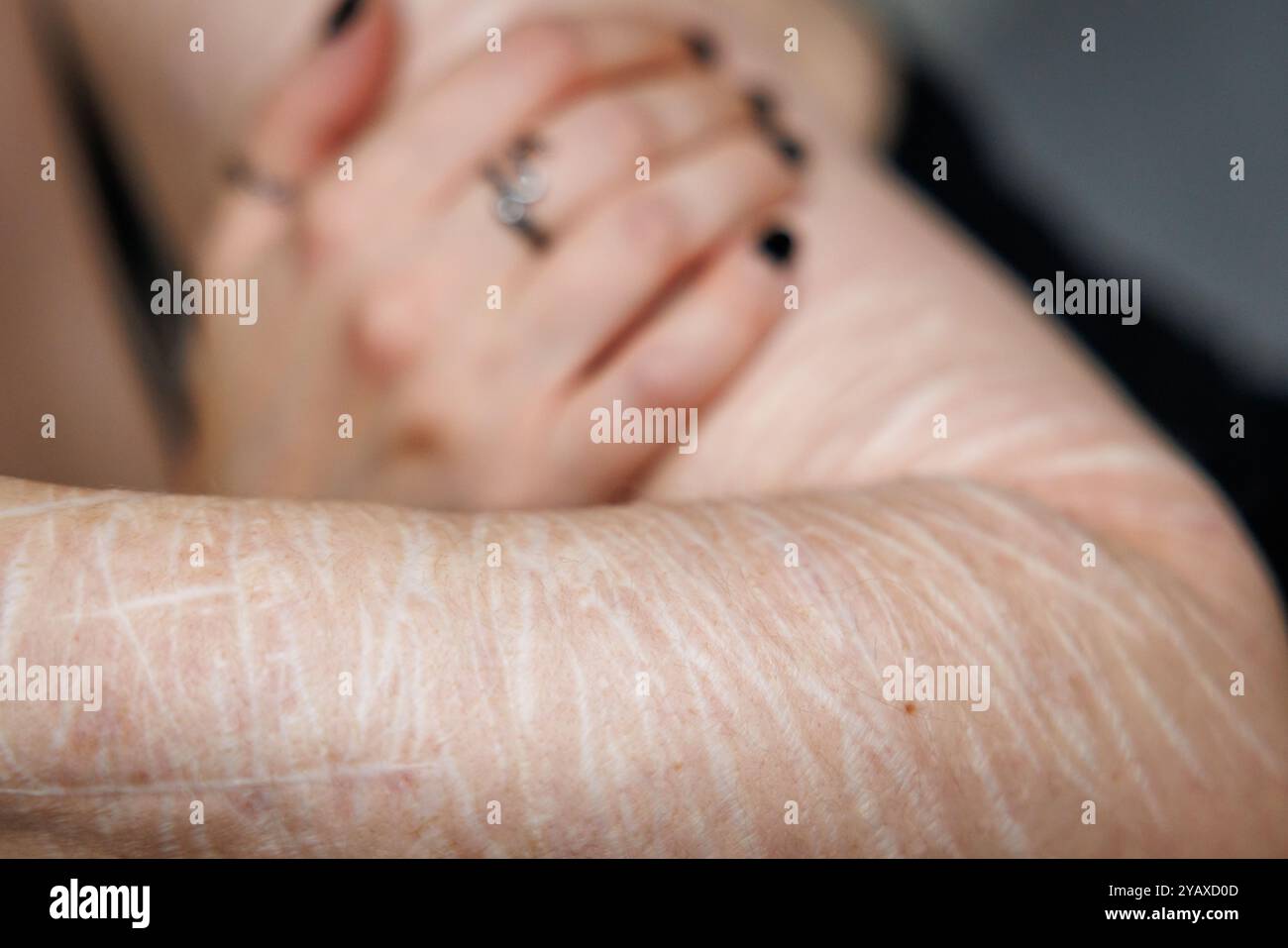 Nürnberg, Deutschland. Oktober 2024. Ein Opfer von selbstverletzendem ...