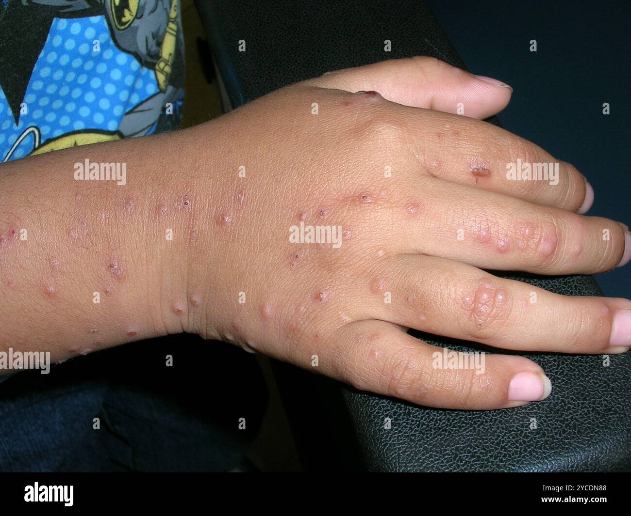 Gianotti-Crosti-Syndrom (infantile papuläre Akrodermatitis) an der Hand ...