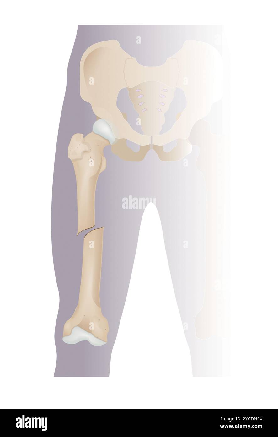 Illustration einer spiralförmigen Femurfraktur. Eine Drehkraft am ...