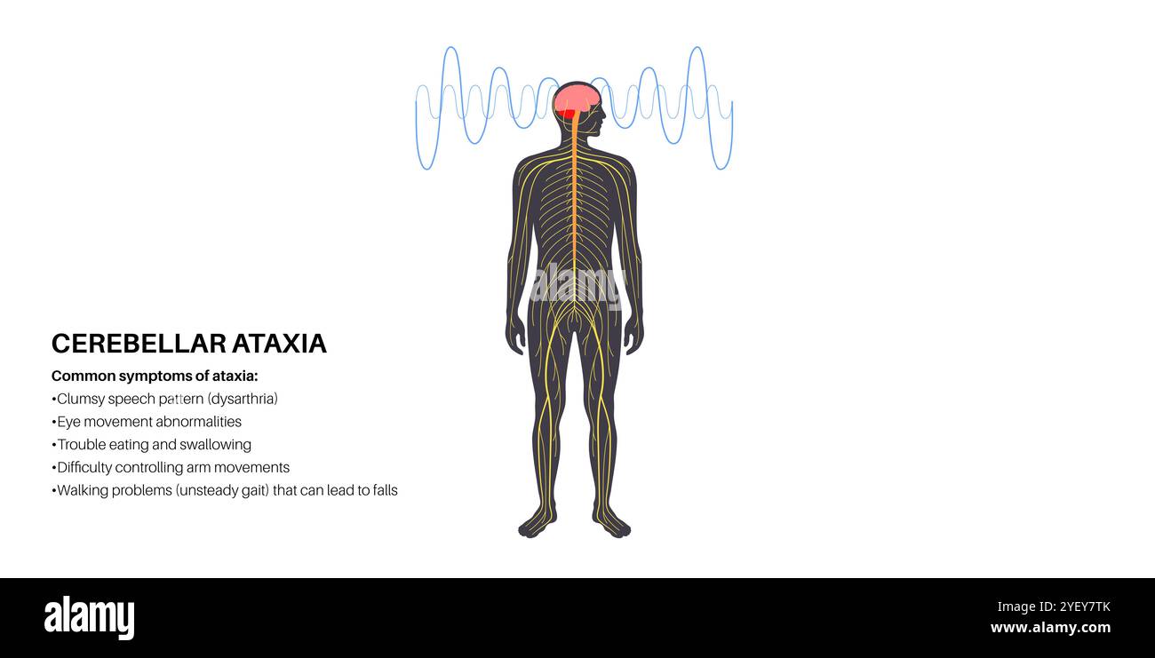 Konzeptuelle Darstellung der Kleinhirnataxie. Ataxie ist eine Störung ...