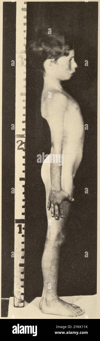 Bloom syndrom -Fotos und -Bildmaterial in hoher Auflösung – Alamy