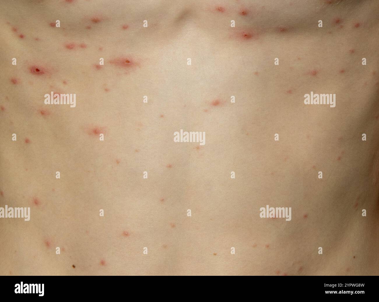 Windpockenausschlag an der Leiche eines Jungen. Windpocken sind eine ...