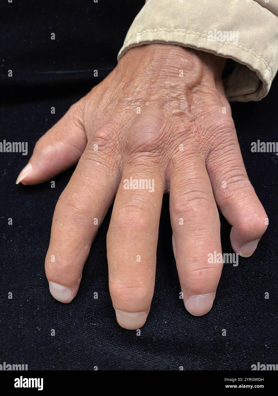 Sklerodermie verursacht schwere Schwellungen (Daktylitis) der Finger ...