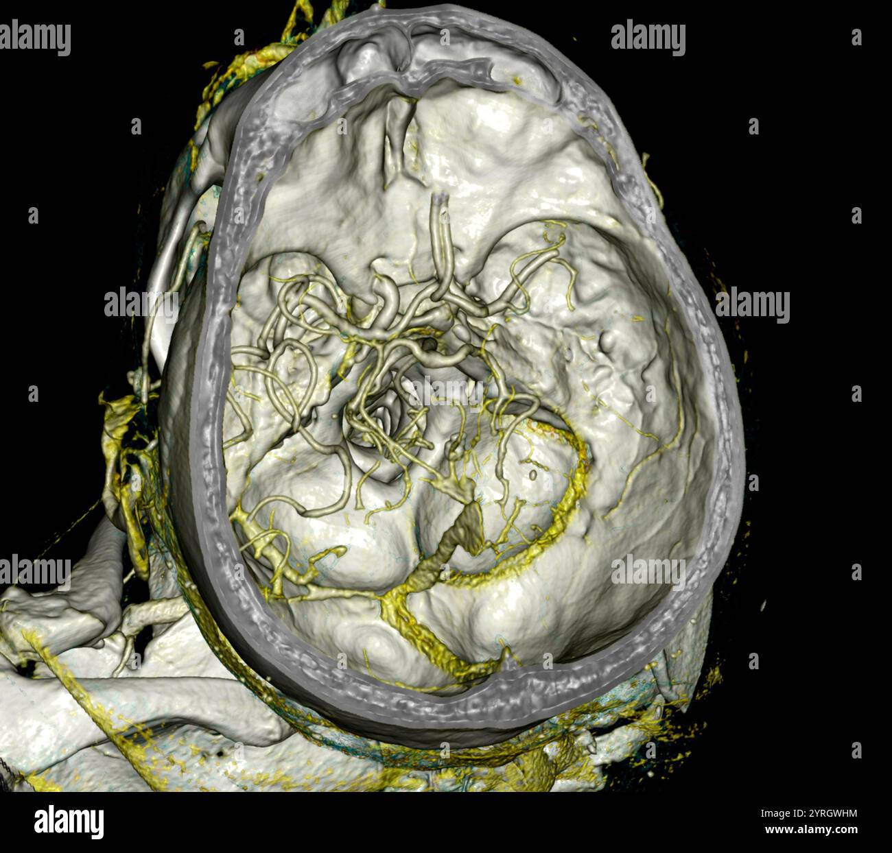 Magnetresonanztomographie (MRT) Angiogramm eines axialen Schnitts durch ...