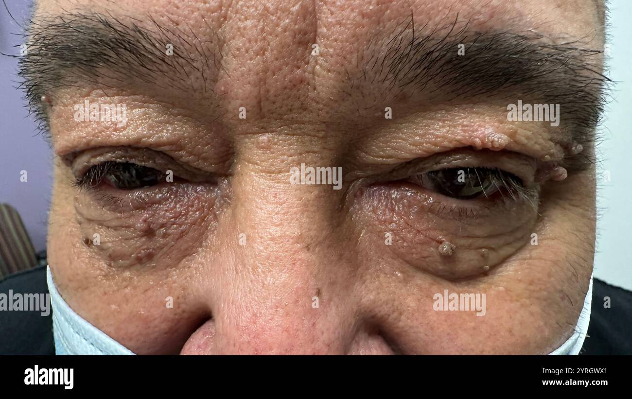 Hautmarkierungen an den Augenlidern eines Patienten. Ein ...