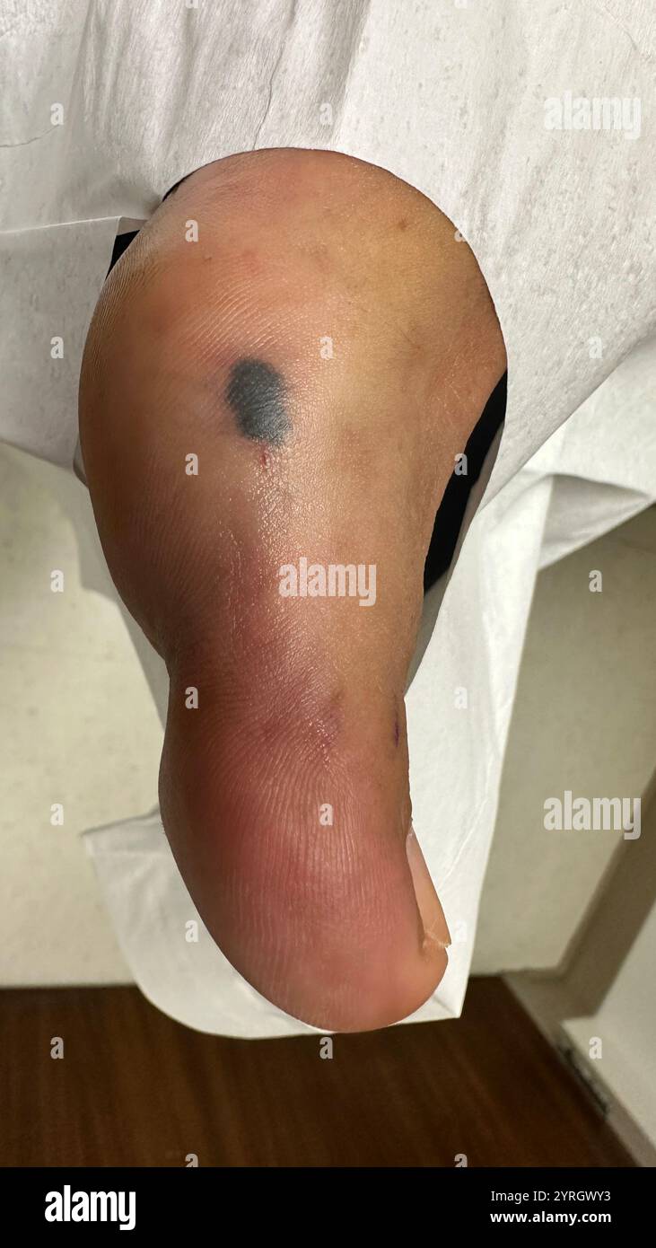 Fuß eines Patienten mit blauem Naevus, der für eine Biopsie vorbereitet ...