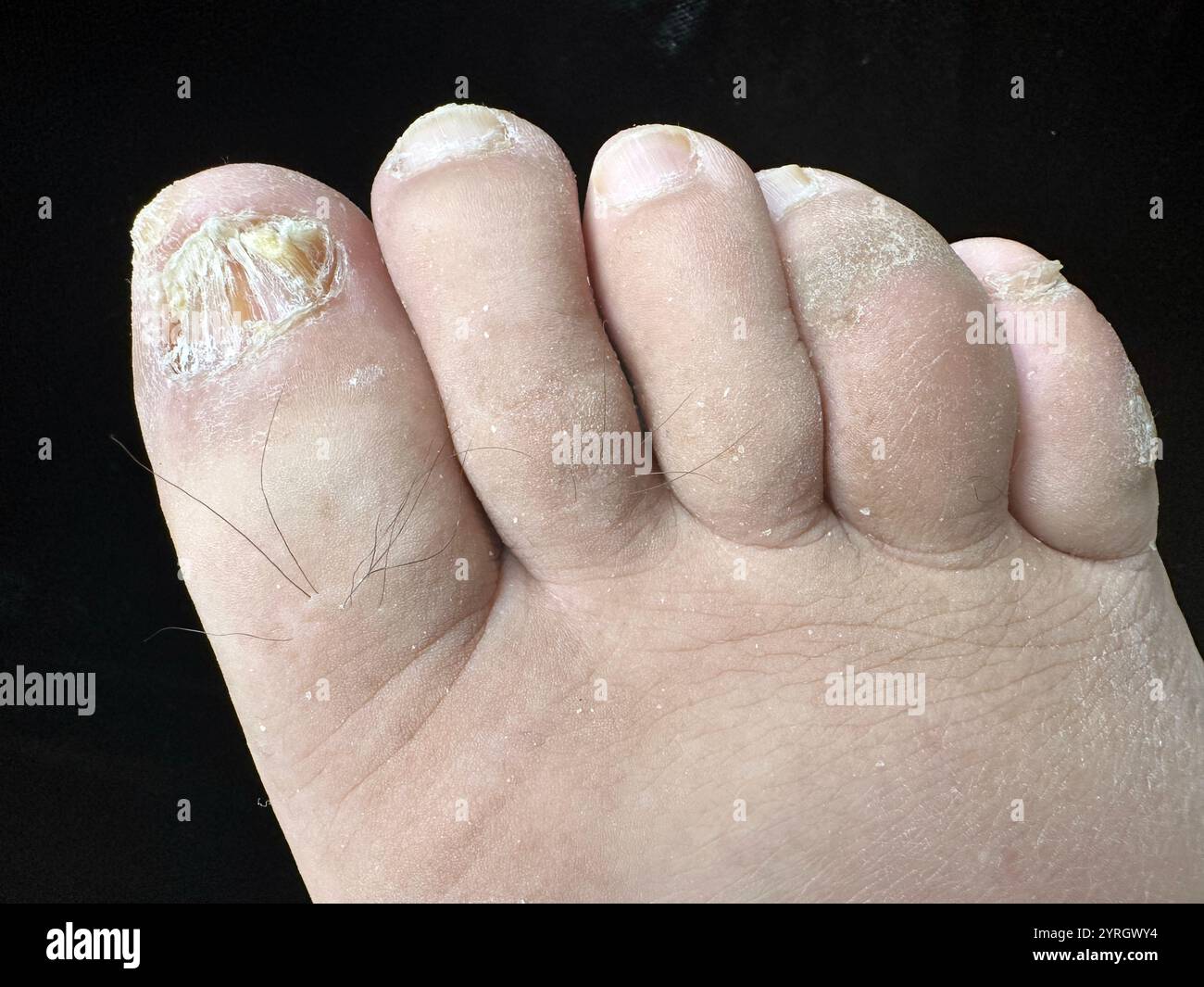 Psoriasis-Arthritis mit Schwellung der Zehen (Daktylitis) und ...