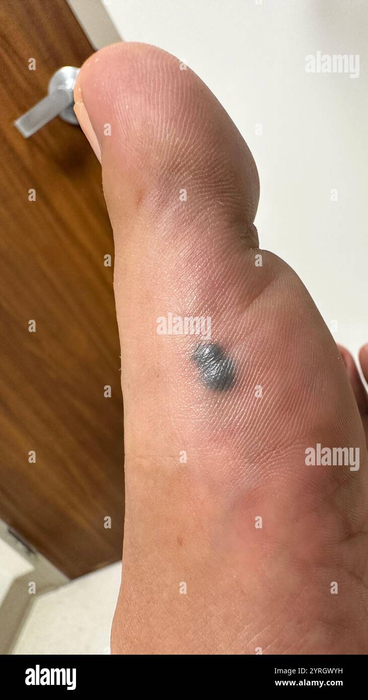 Blauer Naevus am Fuß eines Patienten. Dies ist eine gutartige ...