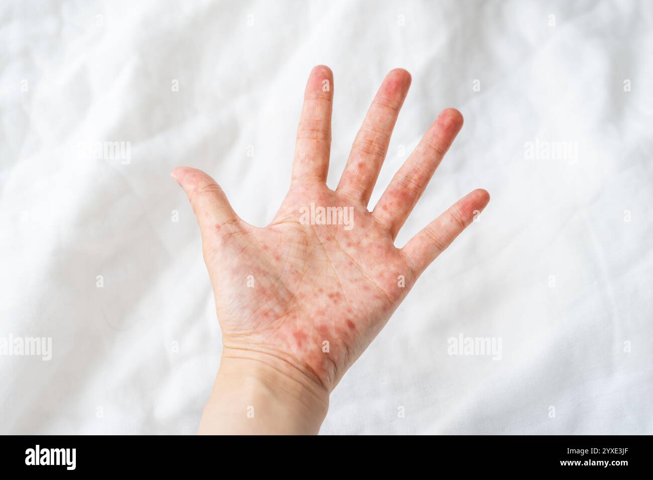 Hand mund fußkrankheit -Fotos und -Bildmaterial in hoher Auflösung – Alamy