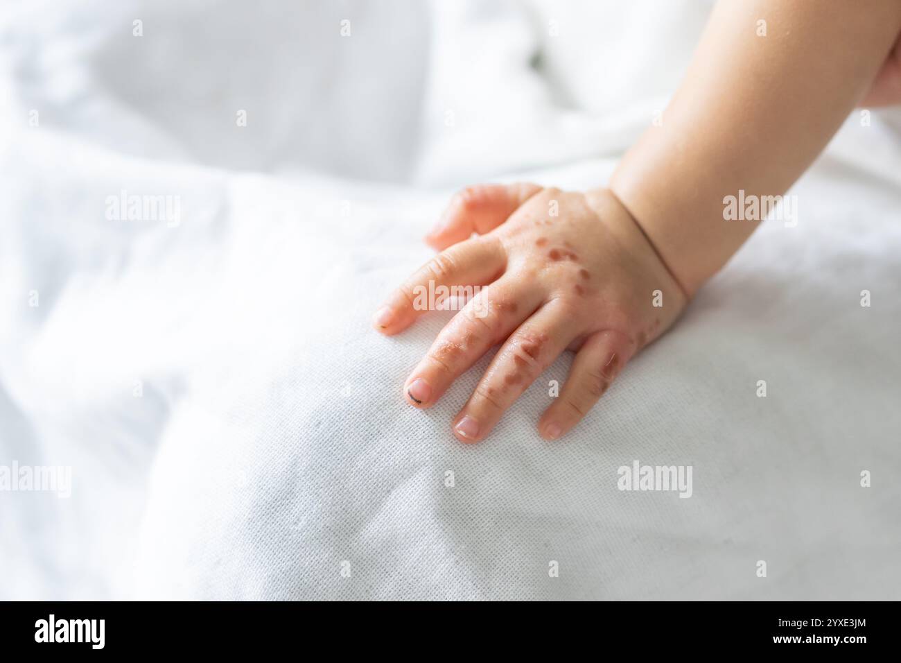 Hand mund fußkrankheit -Fotos und -Bildmaterial in hoher Auflösung – Alamy