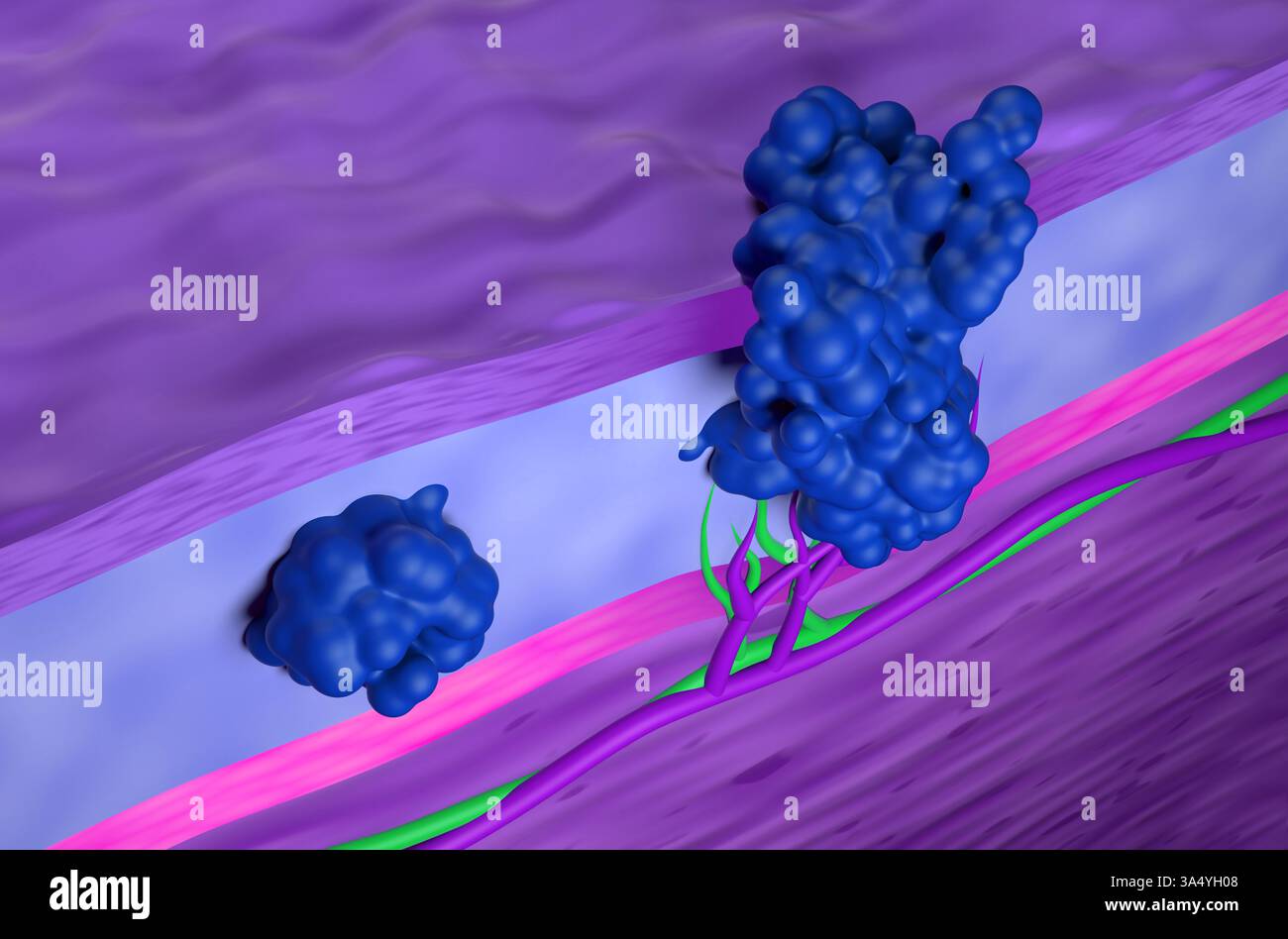 Gutartiger hauttumor -Fotos und -Bildmaterial in hoher Auflösung – Alamy