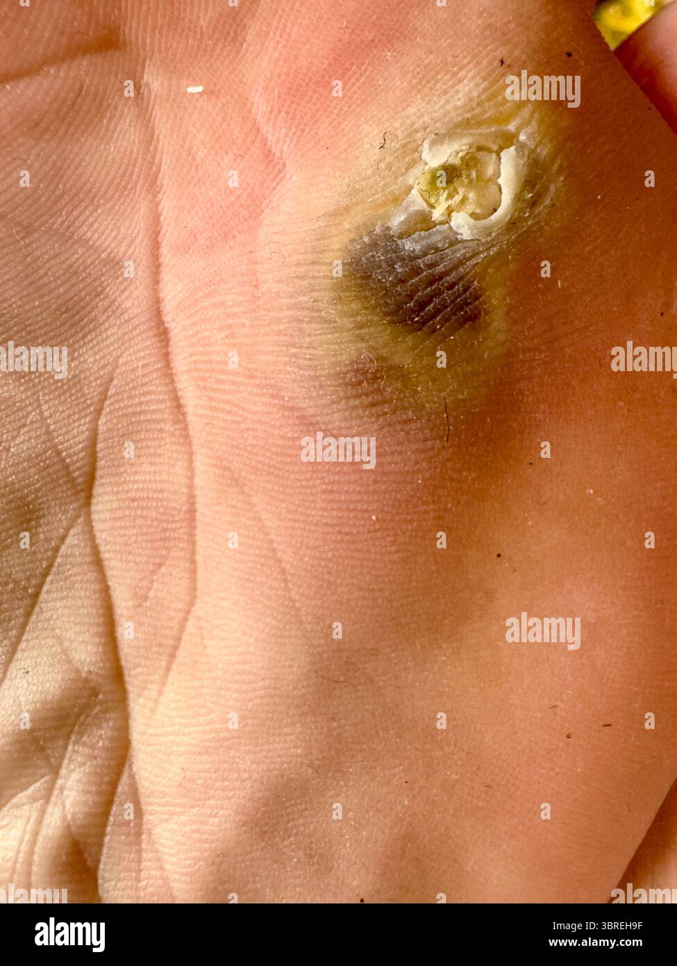 Nahaufnahme einer menschlichen Fußsohle, die eine Plantarwarze mit ...