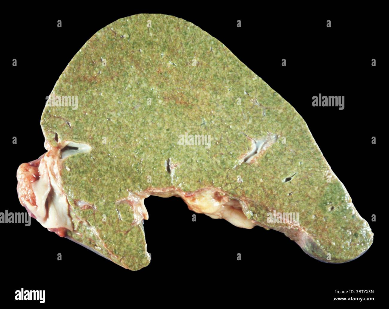 Grobprobe einer von Cholestase betroffenen, abgeschnittenen Leber ...