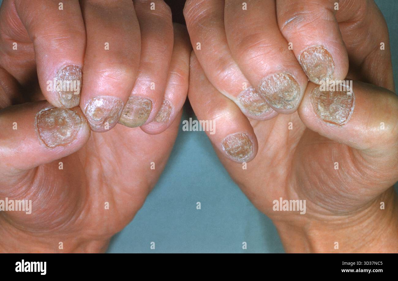 Lichen planus auf den Fingernägeln einer 55-jährigen Frau. Lichen ...