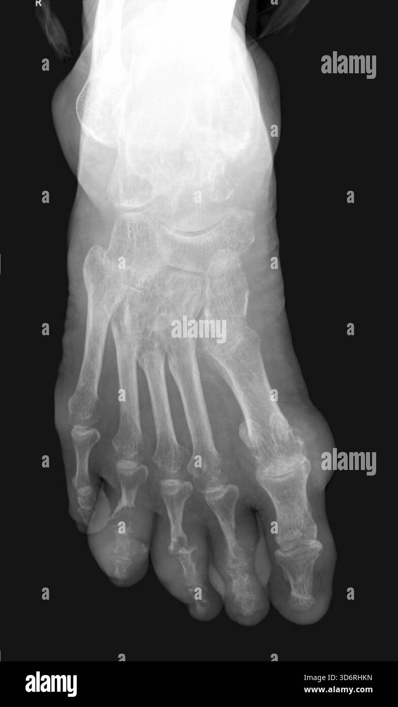 Gicht fuß -Fotos und -Bildmaterial in hoher Auflösung – Alamy