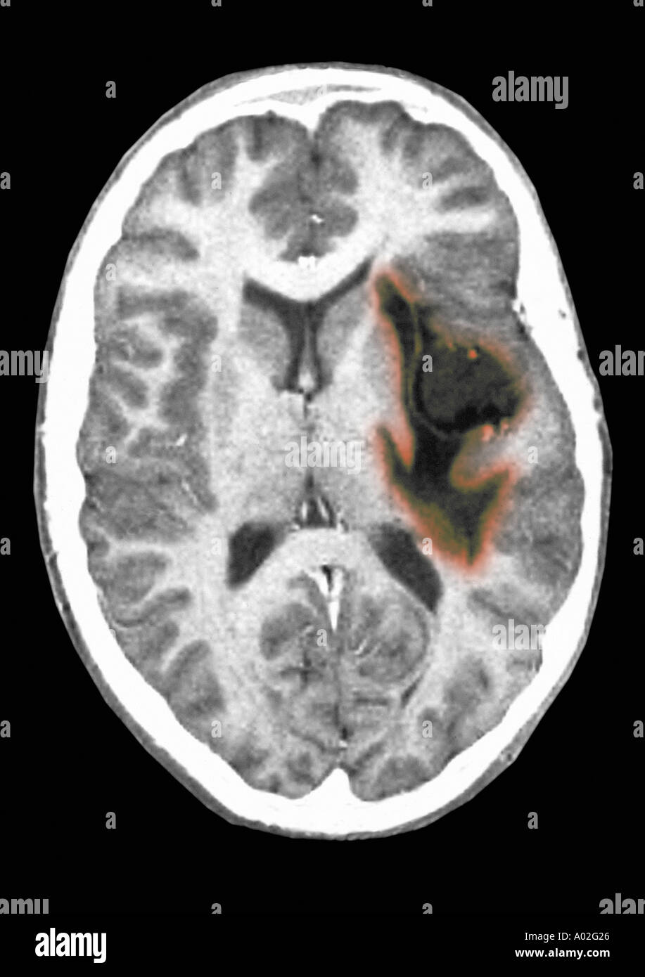 Ct gehirntumor -Fotos und -Bildmaterial in hoher Auflösung – Alamy