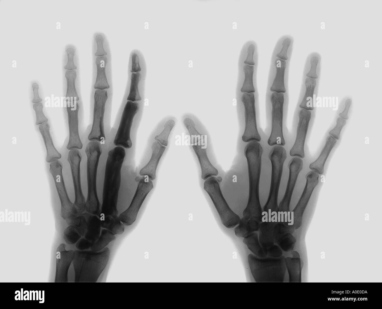 Röntgen der Hände Stockfotografie - Alamy