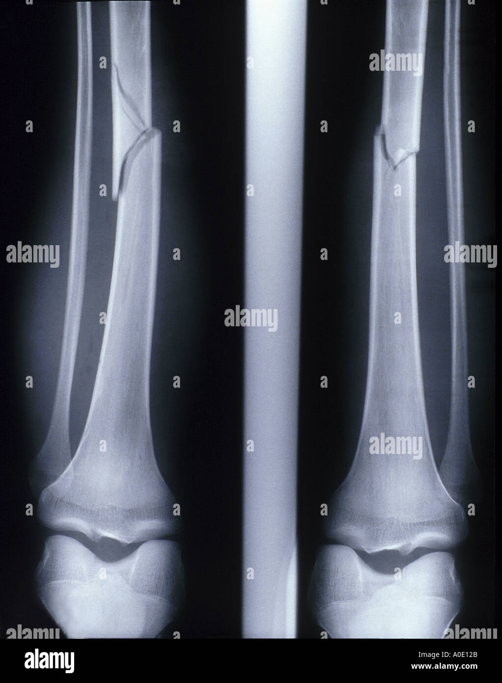 Fraktur tibia -Fotos und -Bildmaterial in hoher Auflösung – Alamy