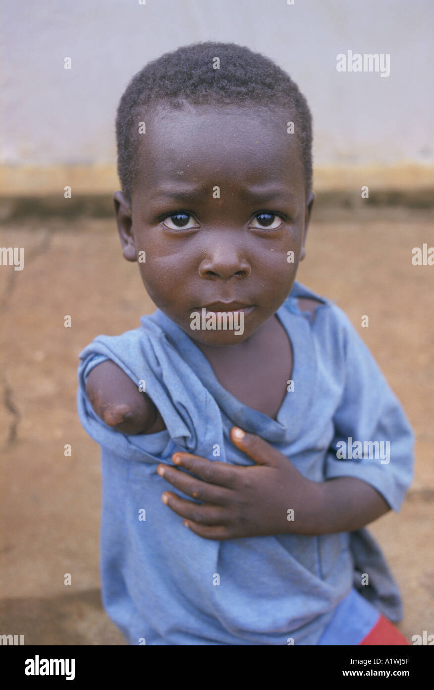 AMPUTIERTE SIERRA LEONE. Kind mit einem ARM AMPUTIERT böswillig von ...
