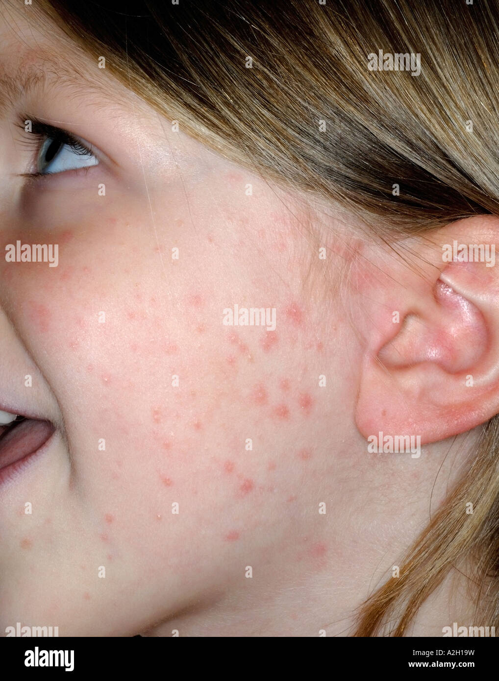 Poison Ivy Toxicodendron Rhus Radicans Dermatitis Hautausschlag ...