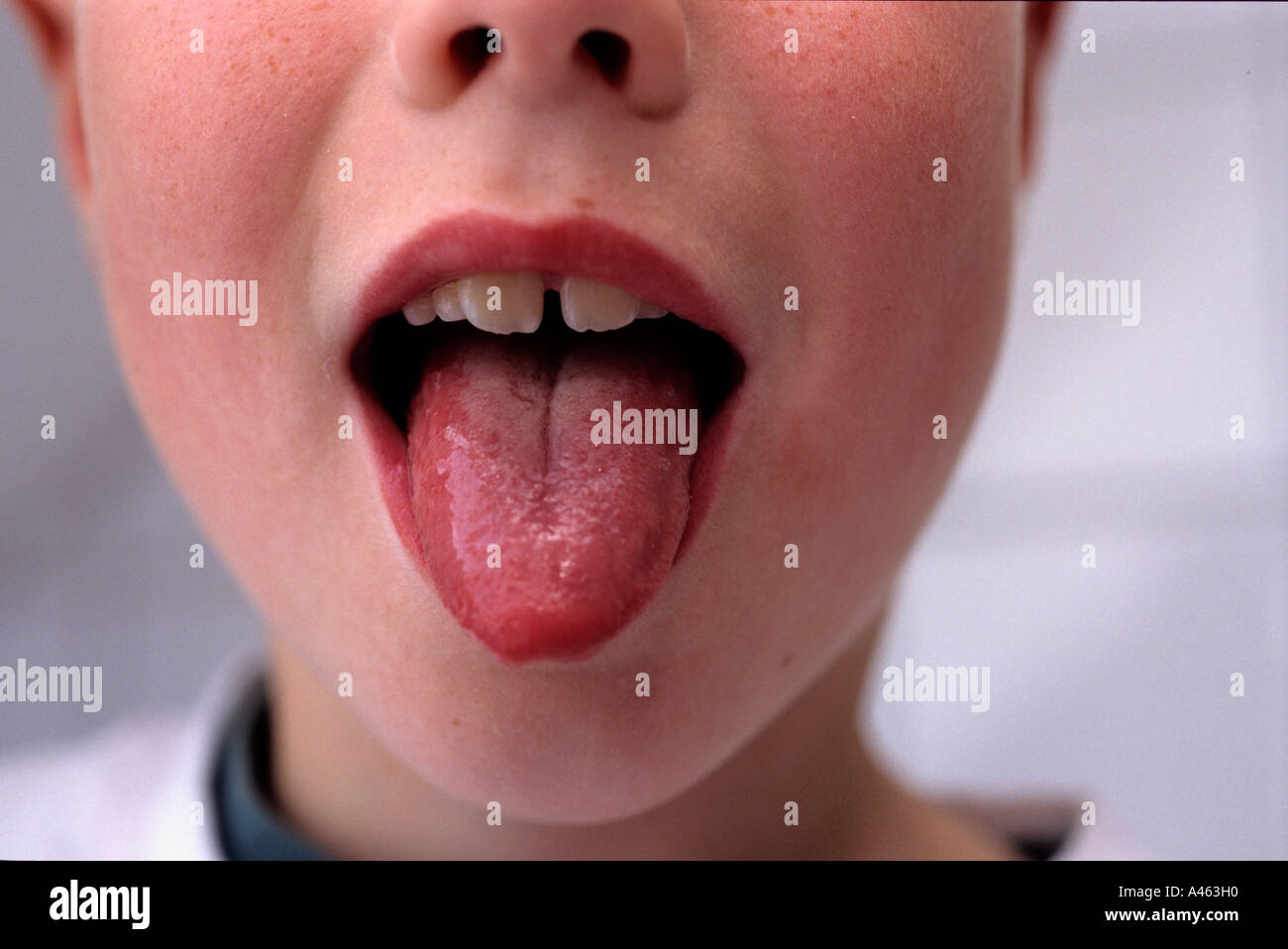 Scharlach kind -Fotos und -Bildmaterial in hoher Auflösung – Alamy