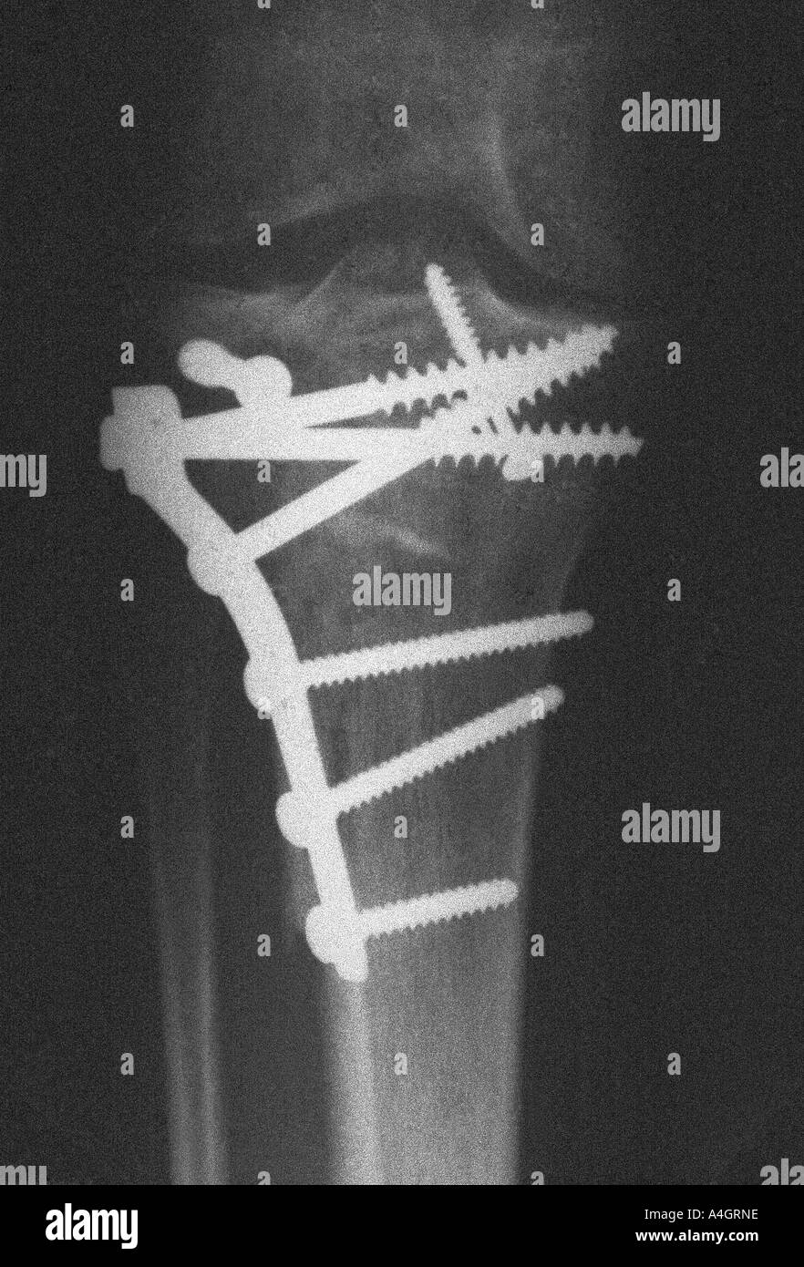 Eine Röntgenaufnahme einer Tibia Plateau-Fraktur mit einer Stütze ...