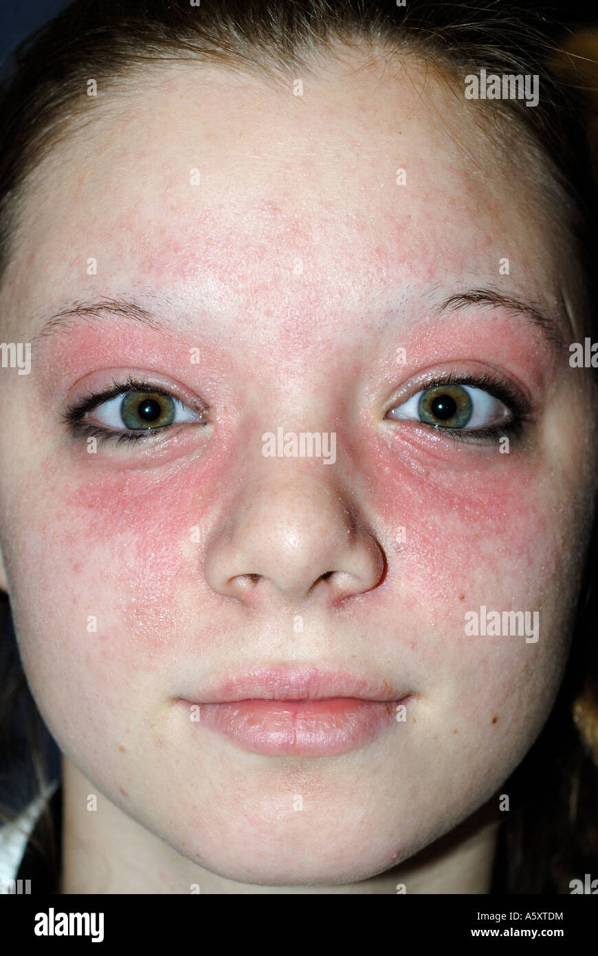 Hautausschlag von Kontaktdermatitis auf den ersten Blick ein 16 Jahre ...