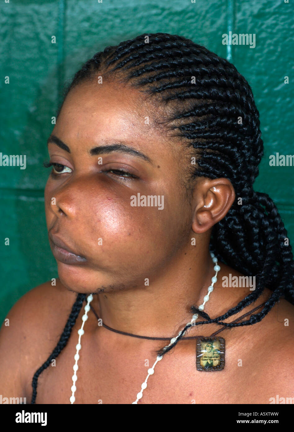 Facial Tumor auf einer Nigerianerin Gewebe Diagnose der fibrösen ...