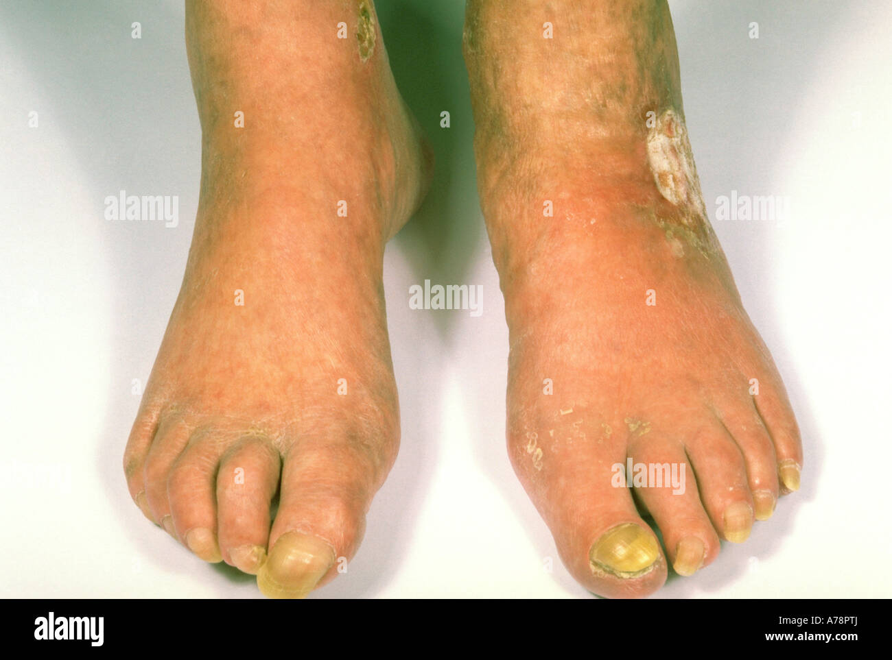 Venösen Ulcus cruris Stockfotografie - Alamy