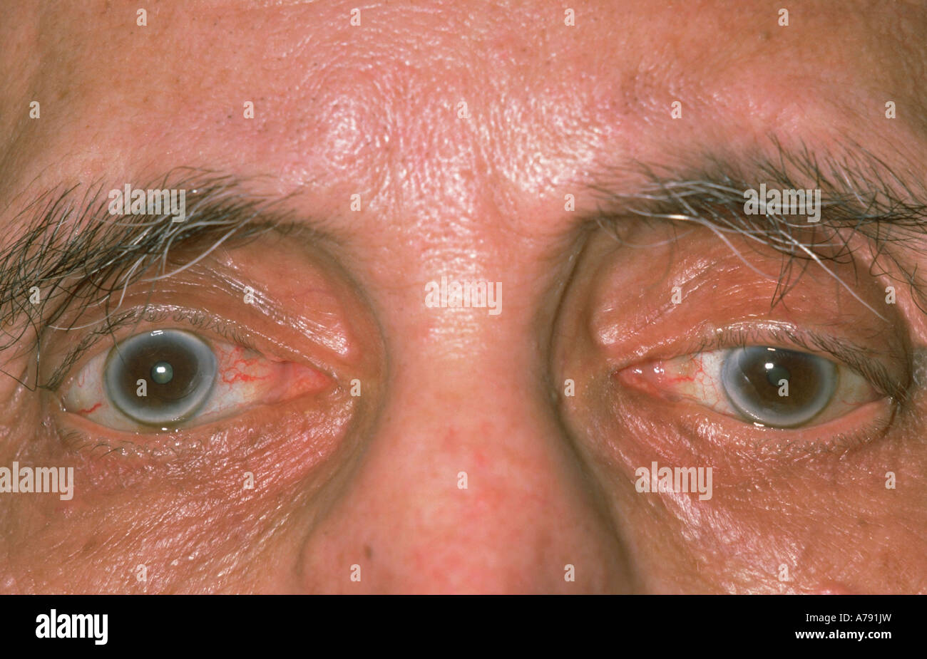 Arcus senilis -Fotos und -Bildmaterial in hoher Auflösung – Alamy