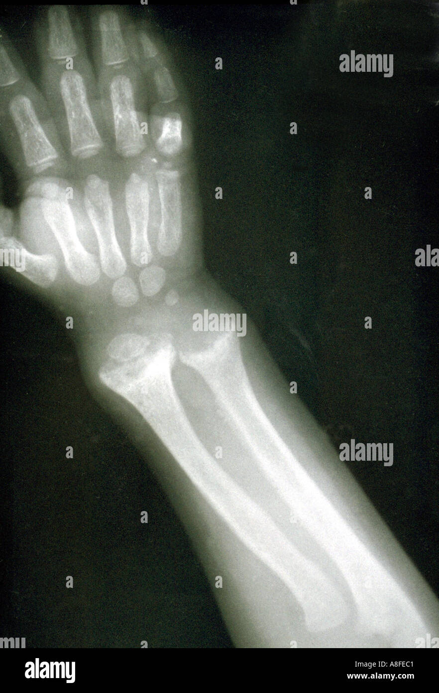 Rickets x ray -Fotos und -Bildmaterial in hoher Auflösung – Alamy