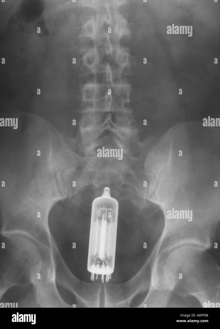 Rektaler fremdkörper -Fotos und -Bildmaterial in hoher Auflösung – Alamy